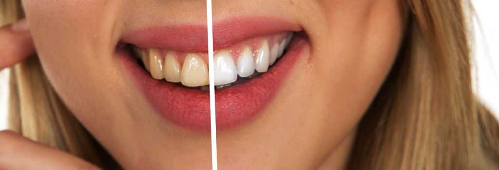 Dazzling White Teeth Headquarters - Dazzling White Teeth HQ Dazzling White Teeth Headquarters - Dazzling White Teeth HQ